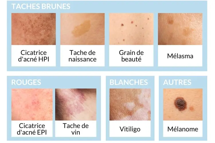 Taches Pigmentaires Causes Pr vention Et Traitements